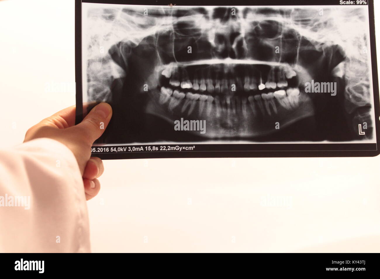 Radiographie des dents Banque de photographies et d’images à haute ...