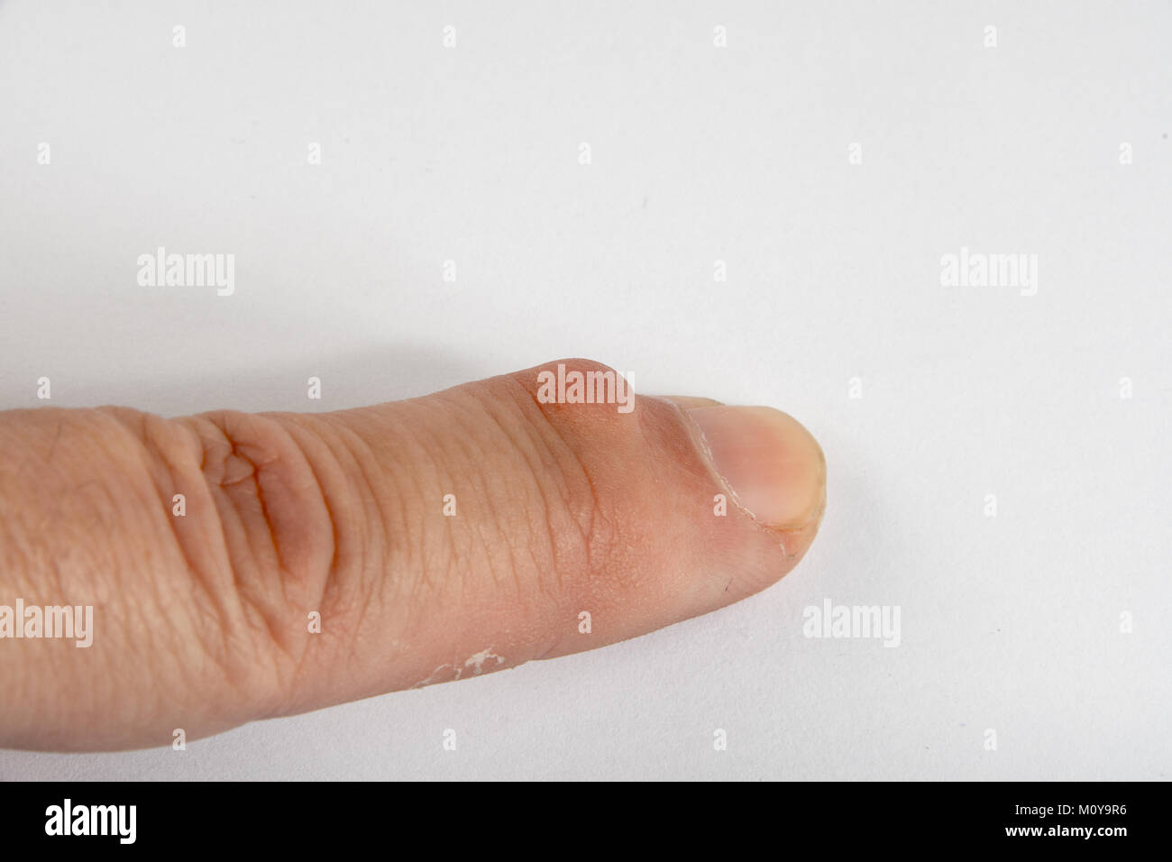 Kystes ganglionnaires croissant sur un doigt Photo Stock - Alamy
