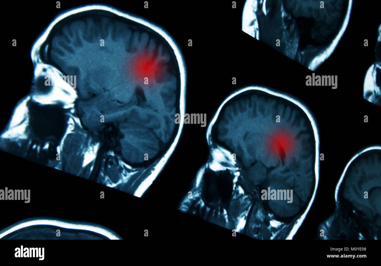 Irm de tumeur au cerveau Banque de photographies et d’images à haute résolution - Page 2 - Alamy