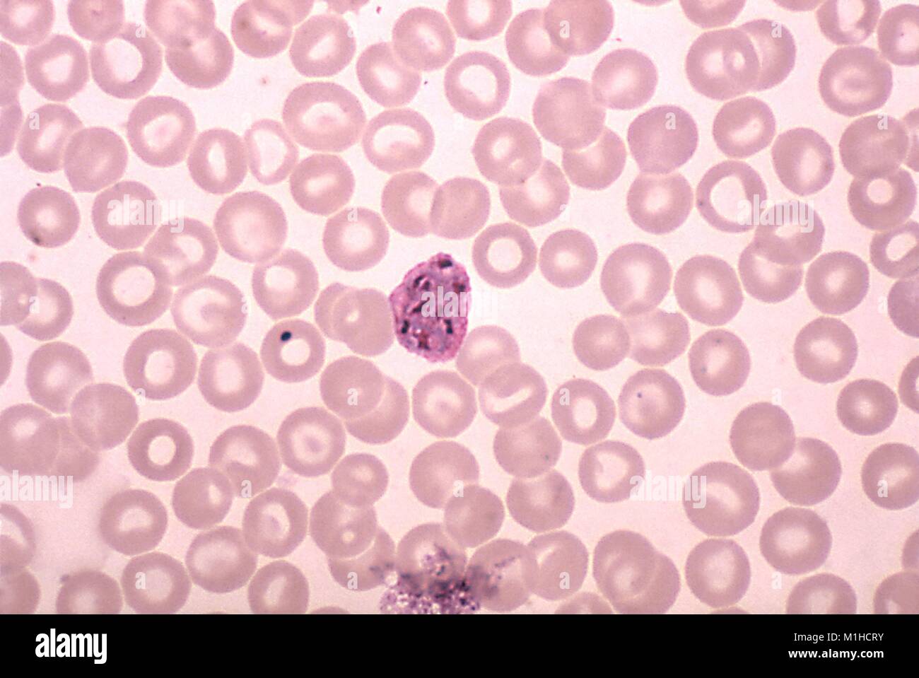 Photomicrographie d'un échantillon de sang à cause du paludisme à P ...