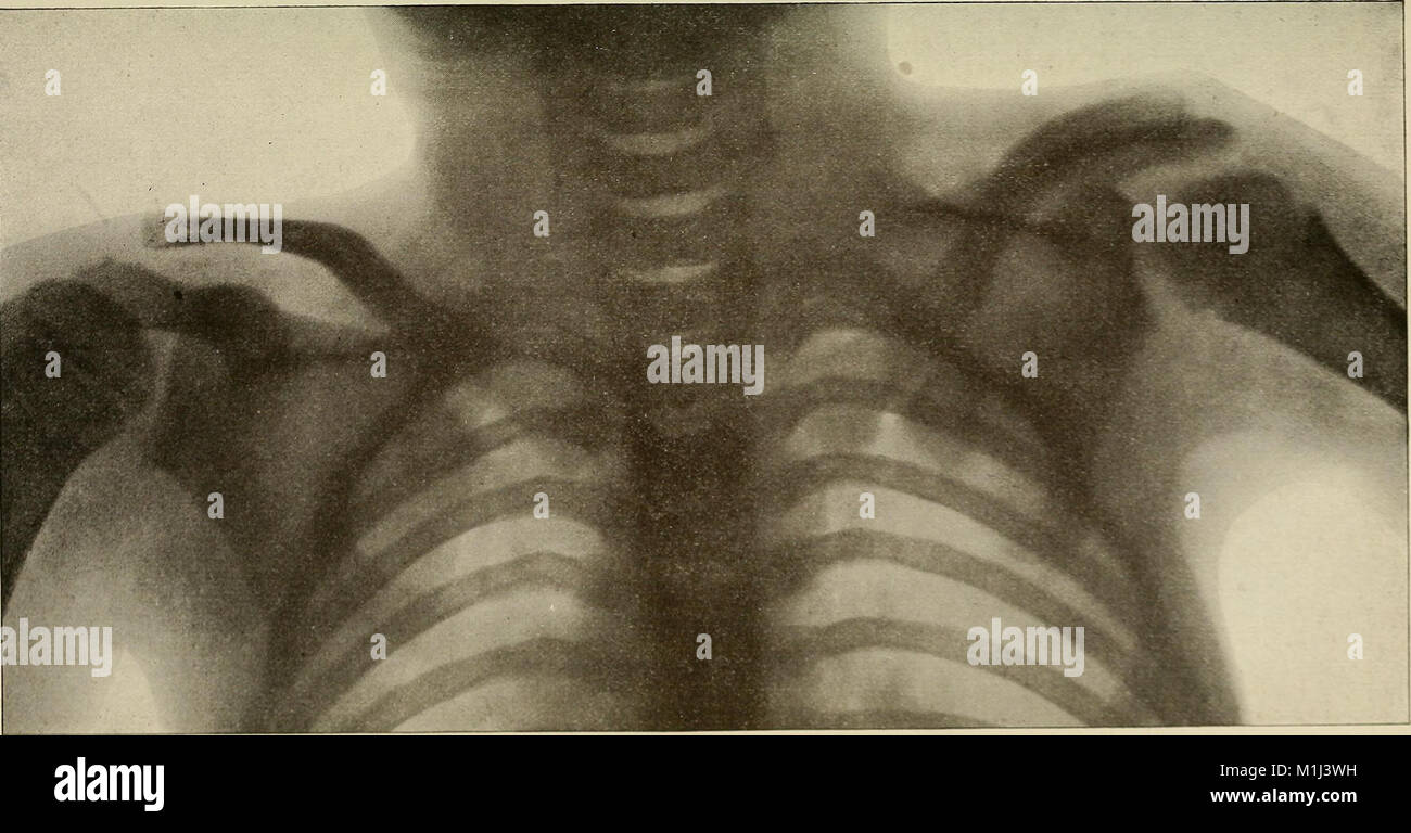 'A Practical Treatise on fractures and luxations' (1907) fournit des ...