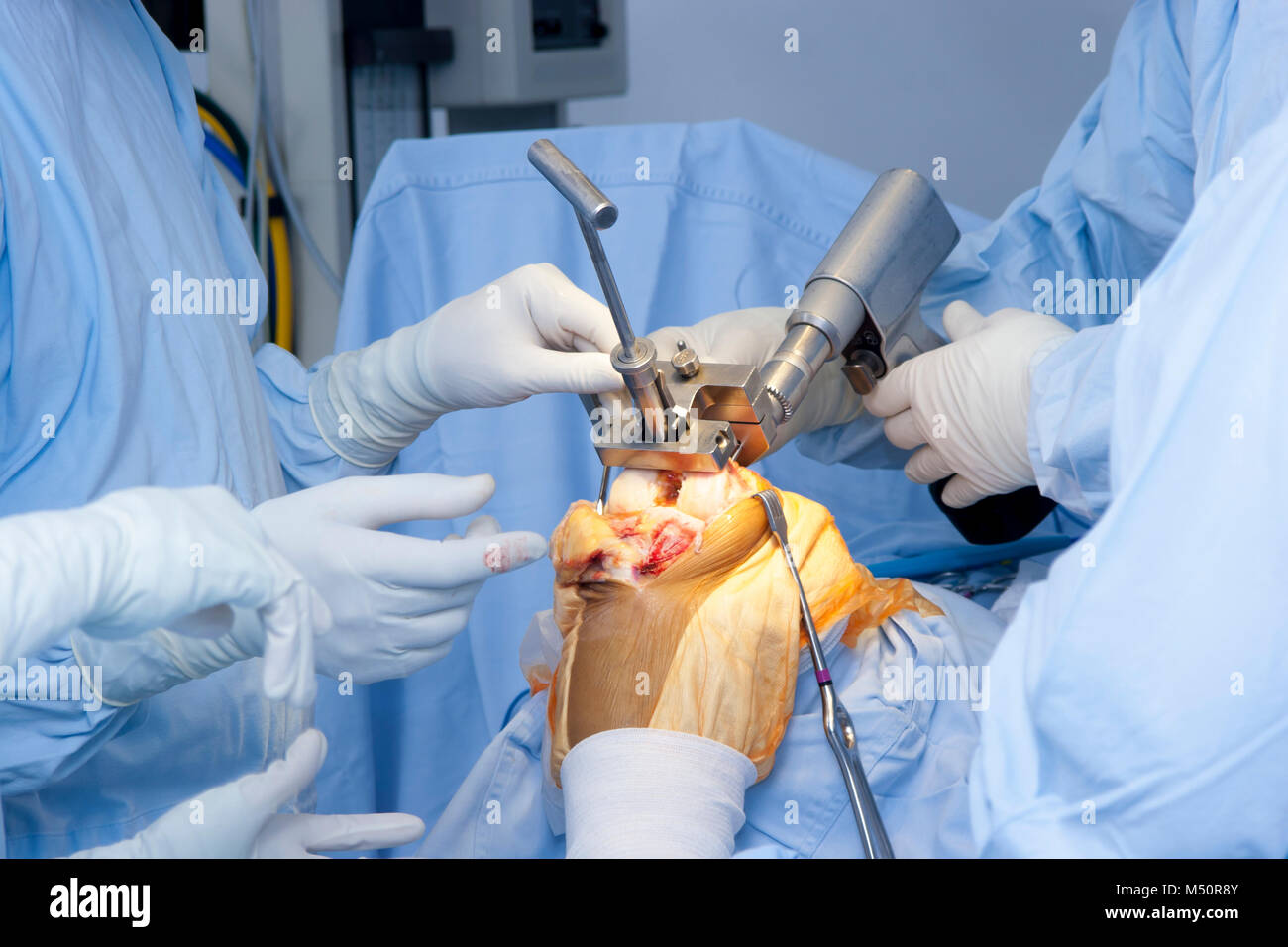 Détail de la chirurgie orthopédique, opération, chirurgie du genou ...