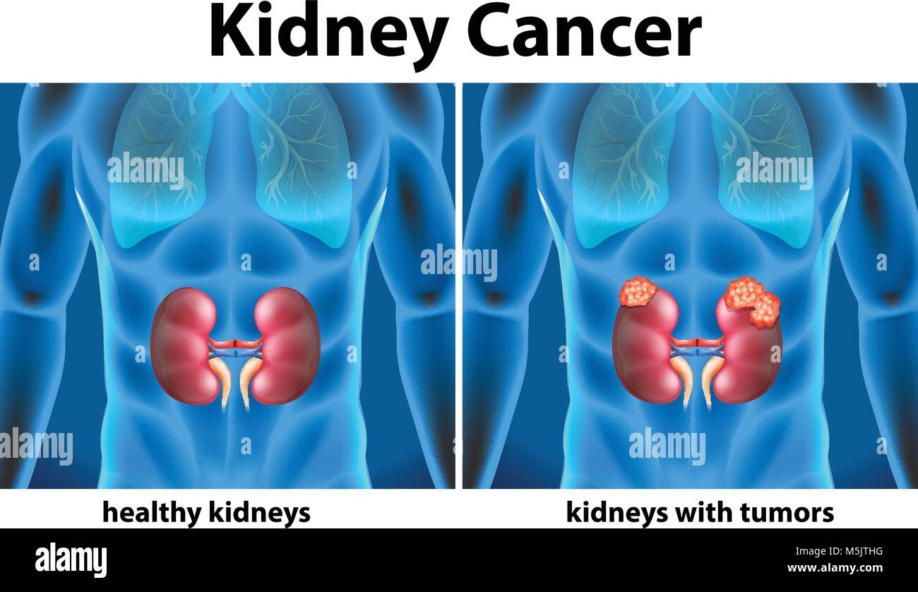 Cancer du rein Banque d'images vectorielles - Alamy