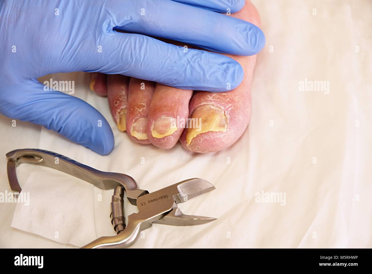 Hallux rigidus Banque de photographies et d’images à haute résolution ...