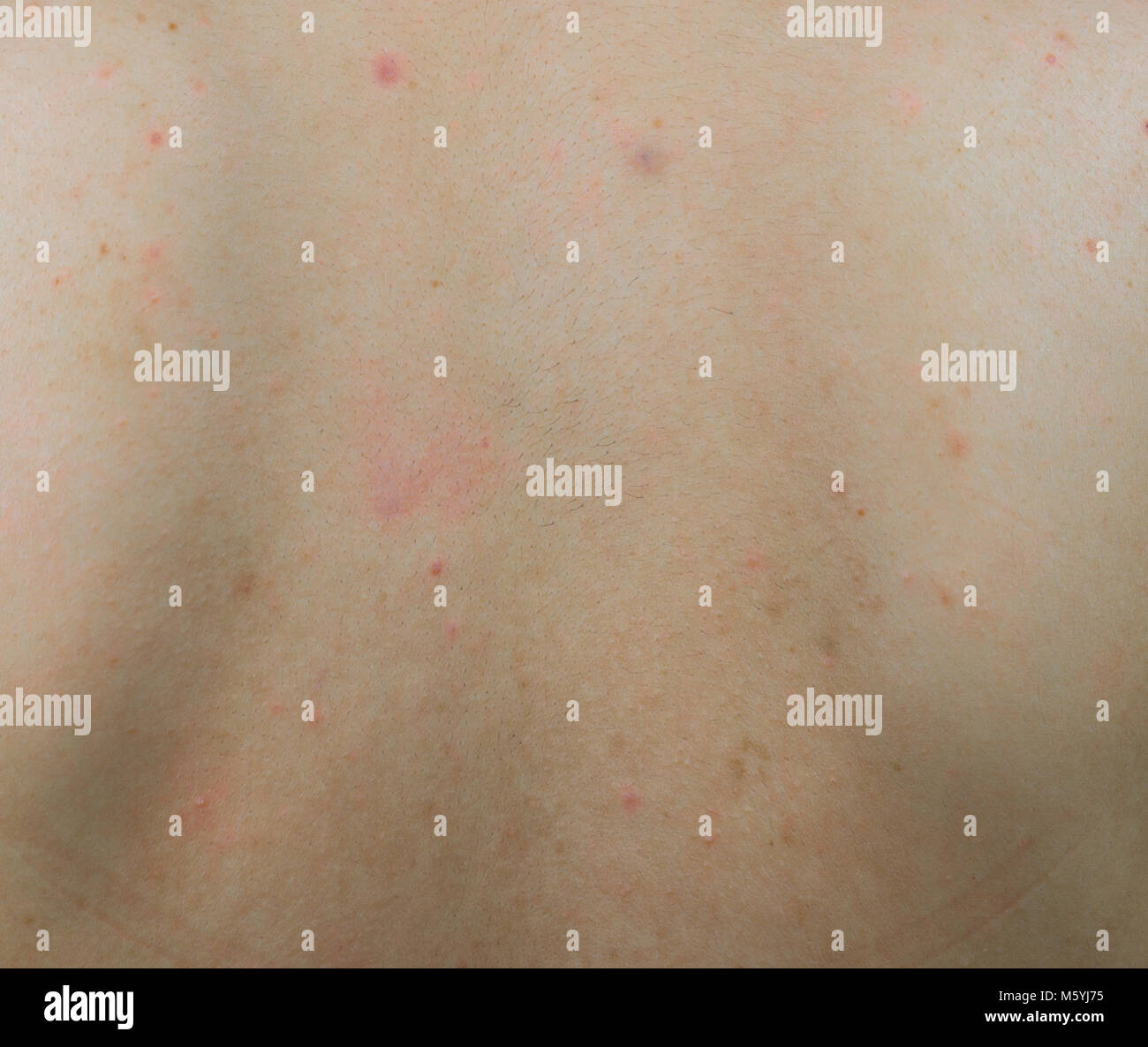 Tache rouge peau Banque de photographies et d’images à haute résolution ...