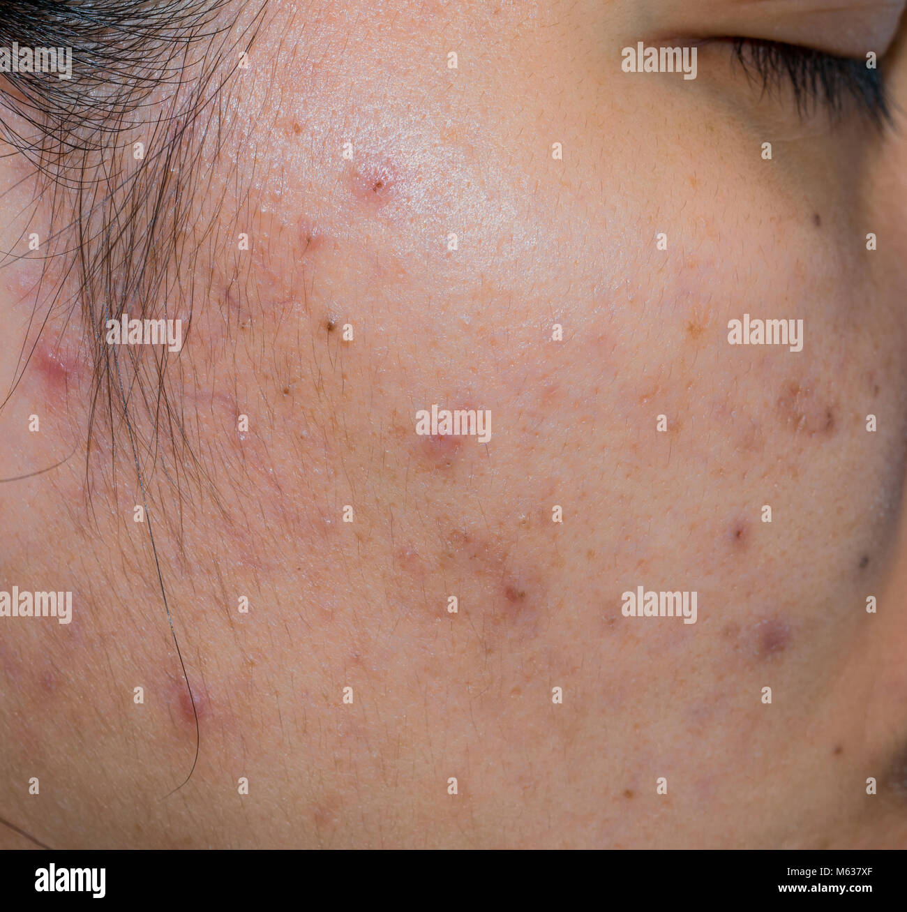 L'acné et l'acné sur la peau du visage grasse of Asian Woman. Concept ...