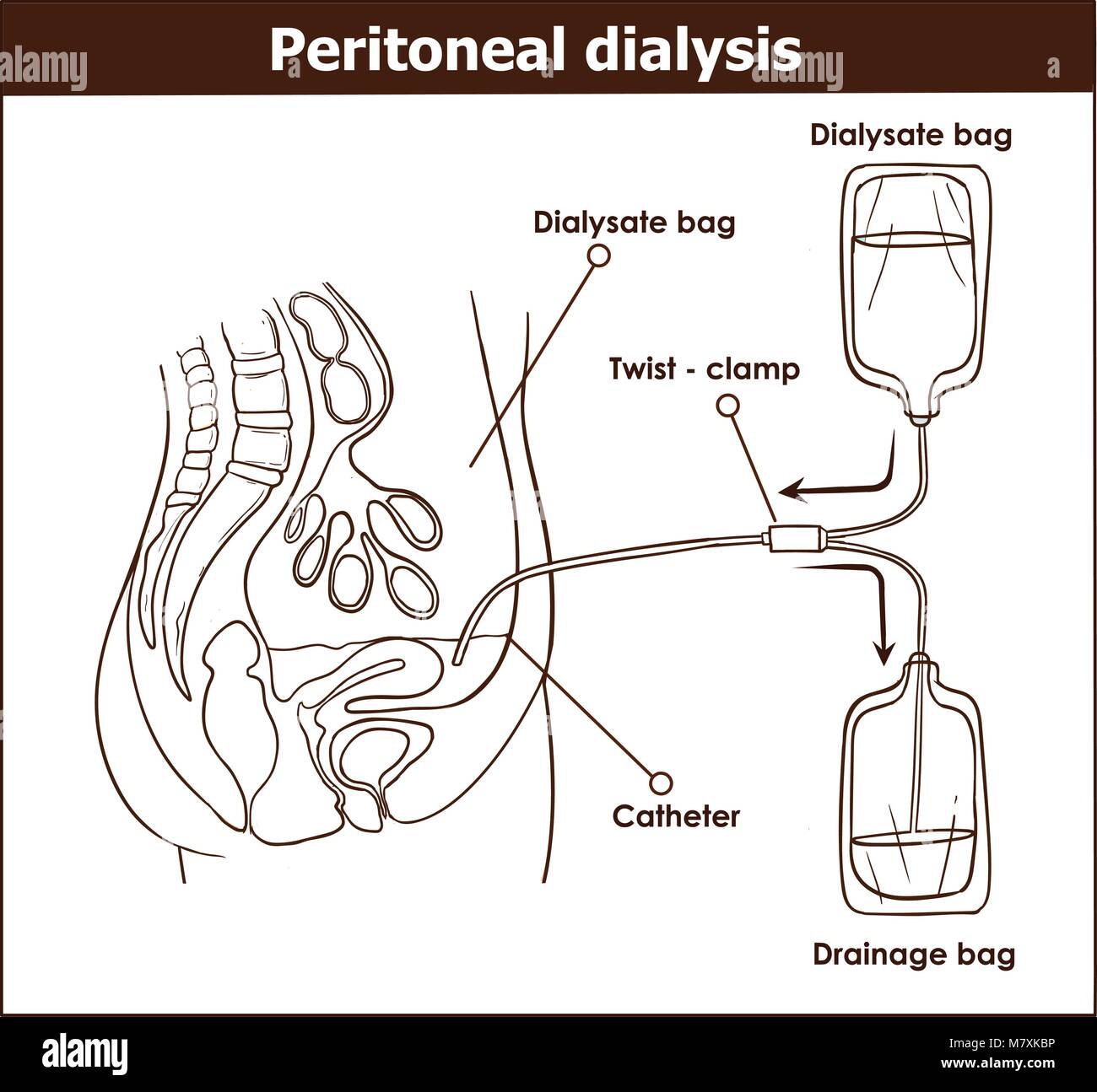 La dialyse péritonéale sont tous deux utilisés pour traiter l ...