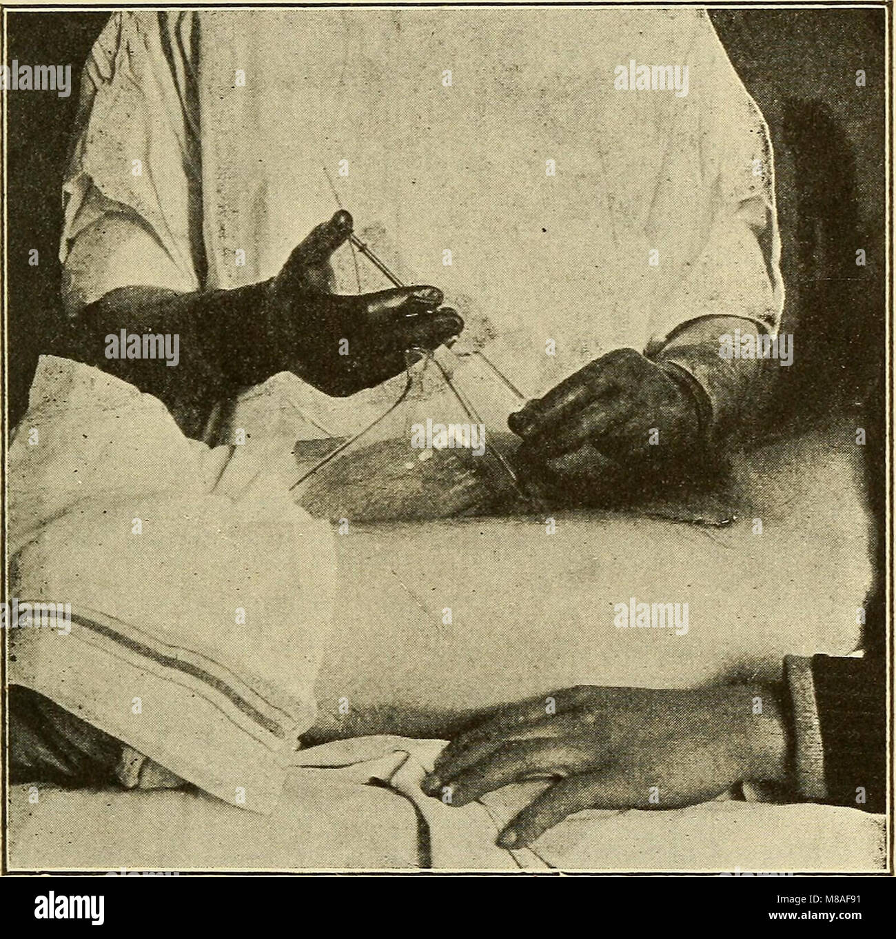 La gonorrhée dans l'homme - guide pratique pour son traitement (1911 ...