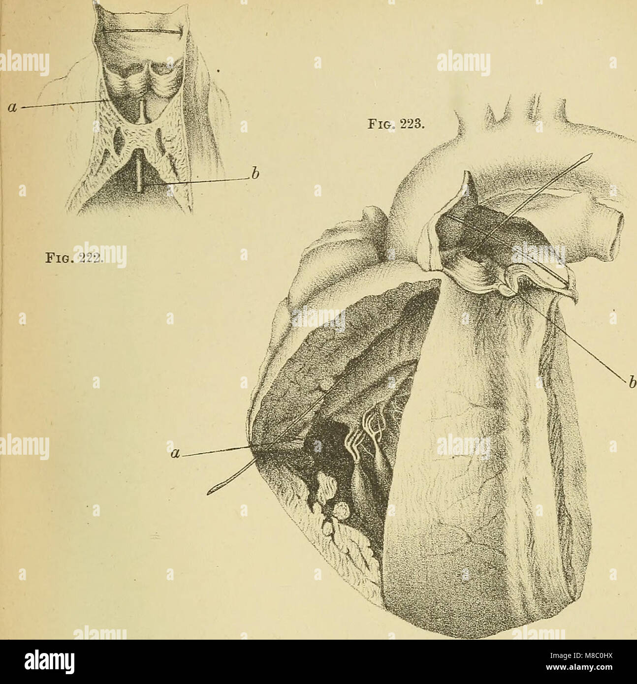 Aorte thoracique Banque de photographies et d’images à haute résolution ...