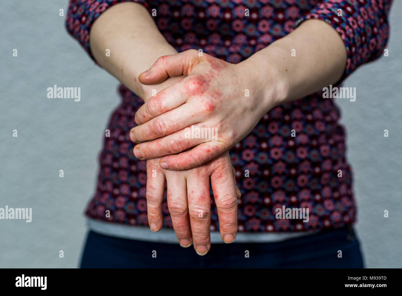 Dyshidrotic eczema Banque de photographies et d’images à haute ...