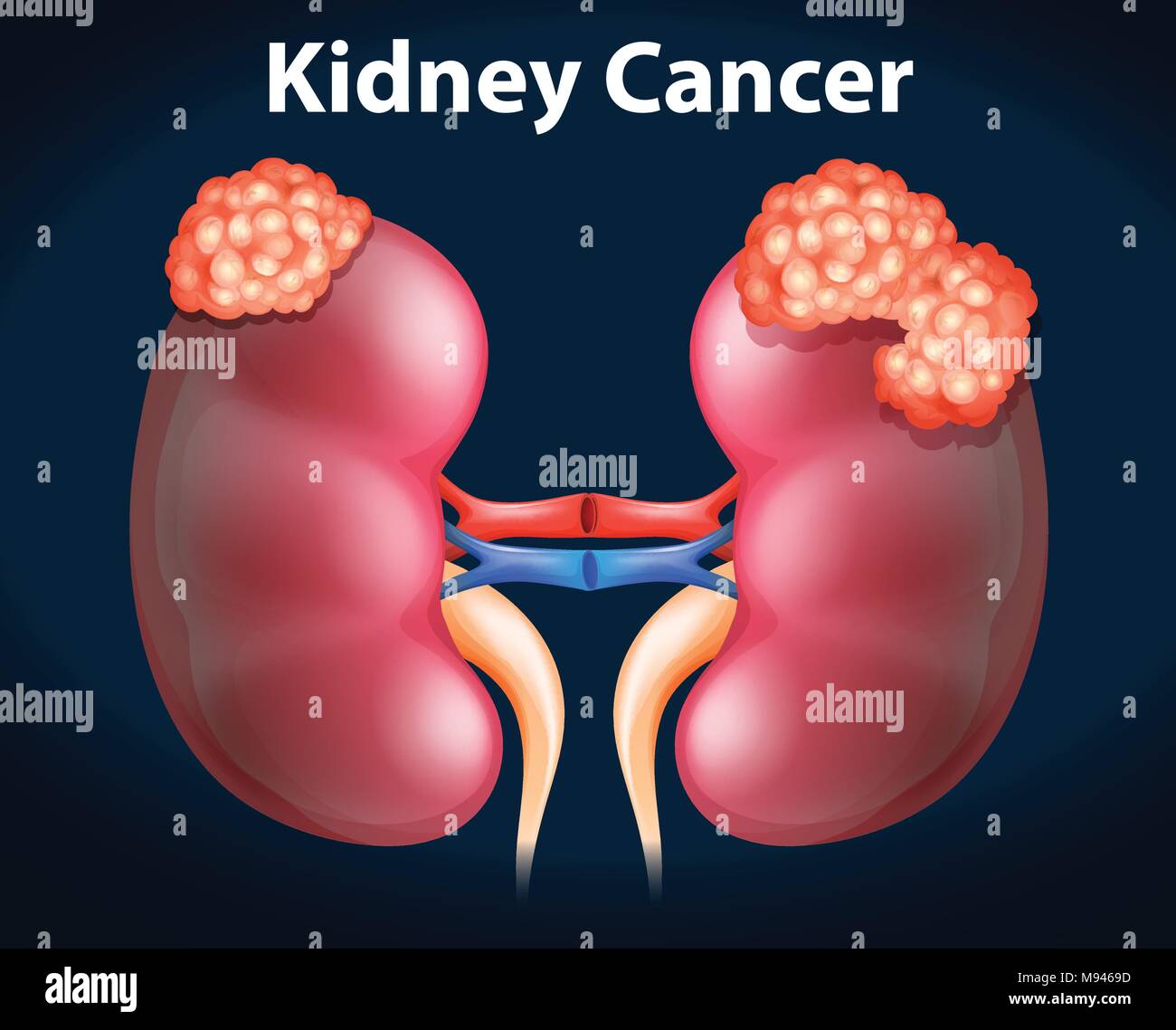 Cancer du rein Banque d'images vectorielles - Alamy