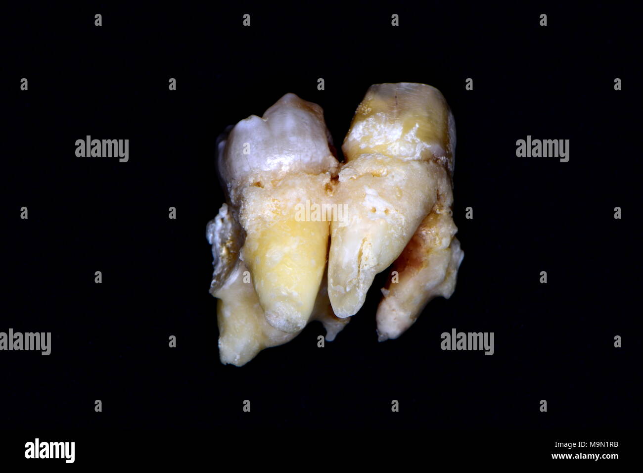 Concrescence des dents Banque de photographies et d’images à haute ...