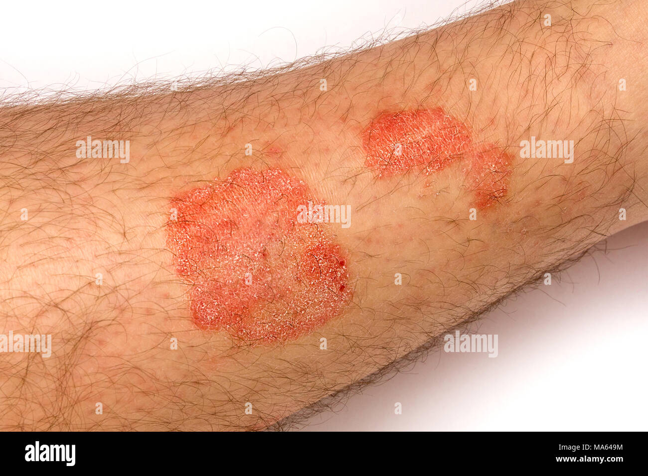 Psoriasis Skin Photos & Psoriasis Skin Images - Page 2 - Alamy