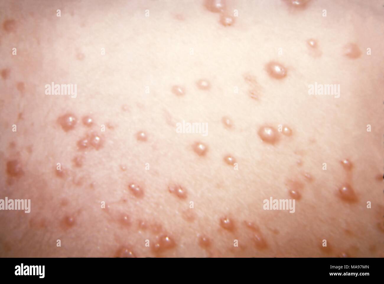 Varicelle herpesviridae Banque de photographies et d’images à haute ...