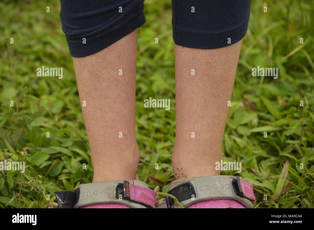 Taches rouges sur le corps Banque de photographies et d’images à haute ...