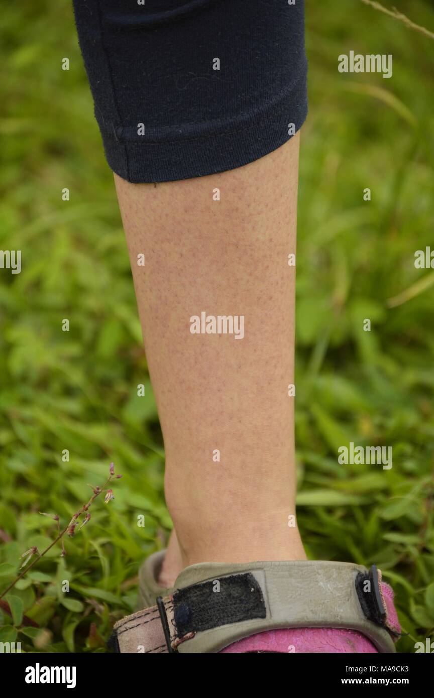 Taches rouges sur le corps Banque de photographies et d’images à haute ...