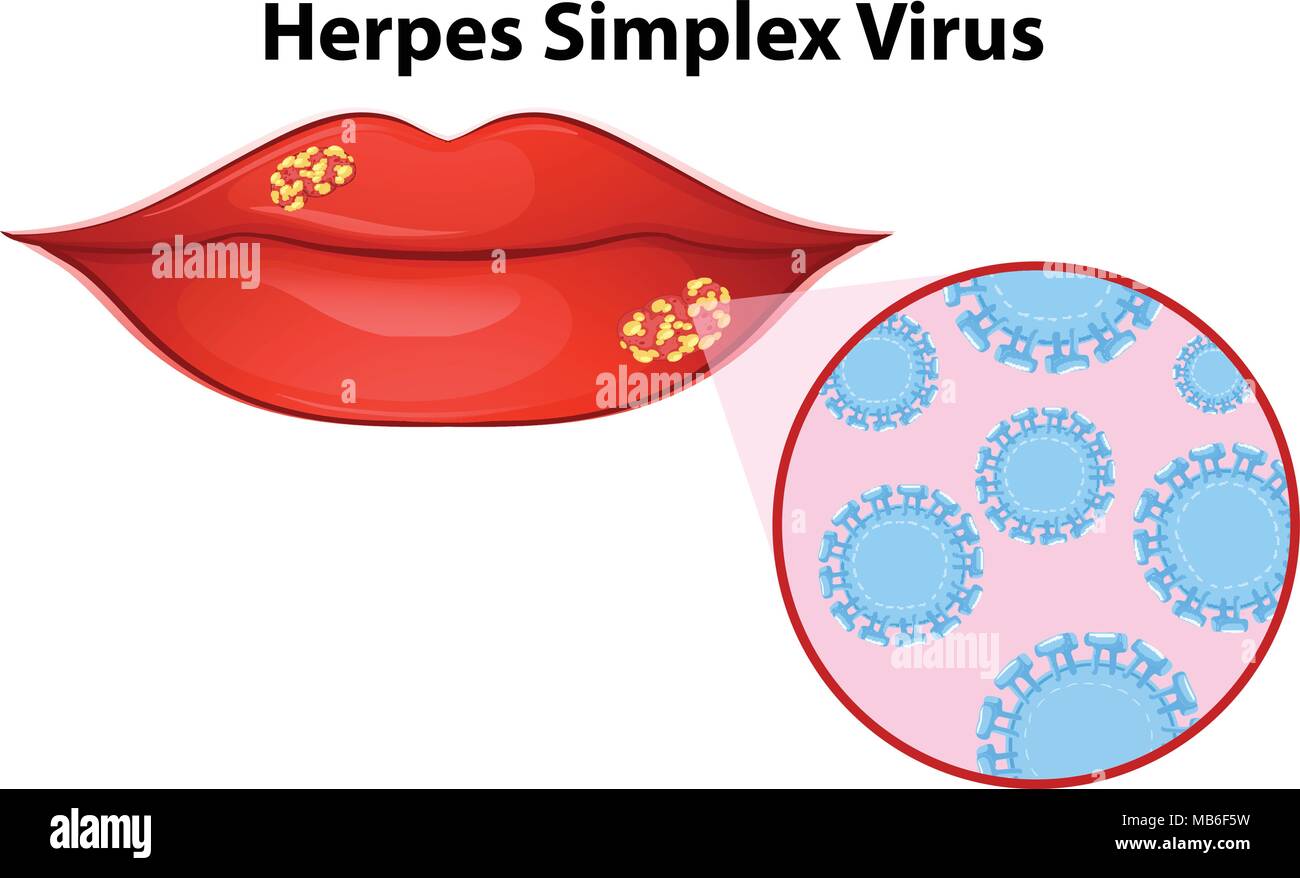 Herpes simplex virus Banque de photographies et d’images à haute ...