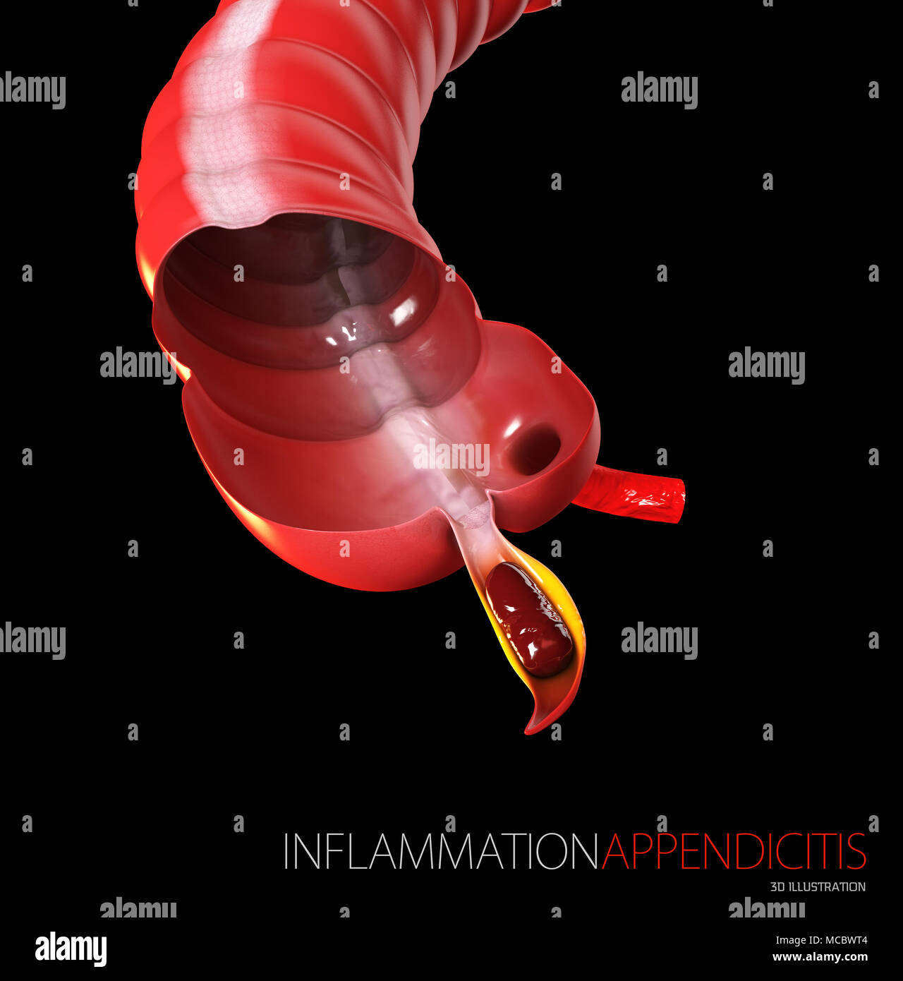 Appendicite diagnostic Banque de photographies et d’images à haute ...