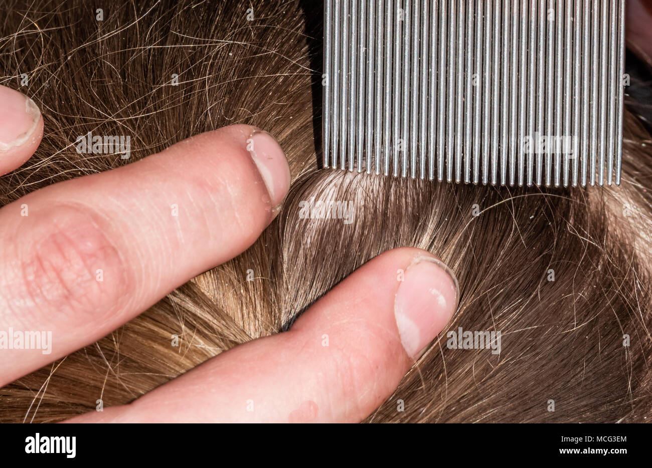 œufs de poux Banque de photographies et d’images à haute résolution - Alamy