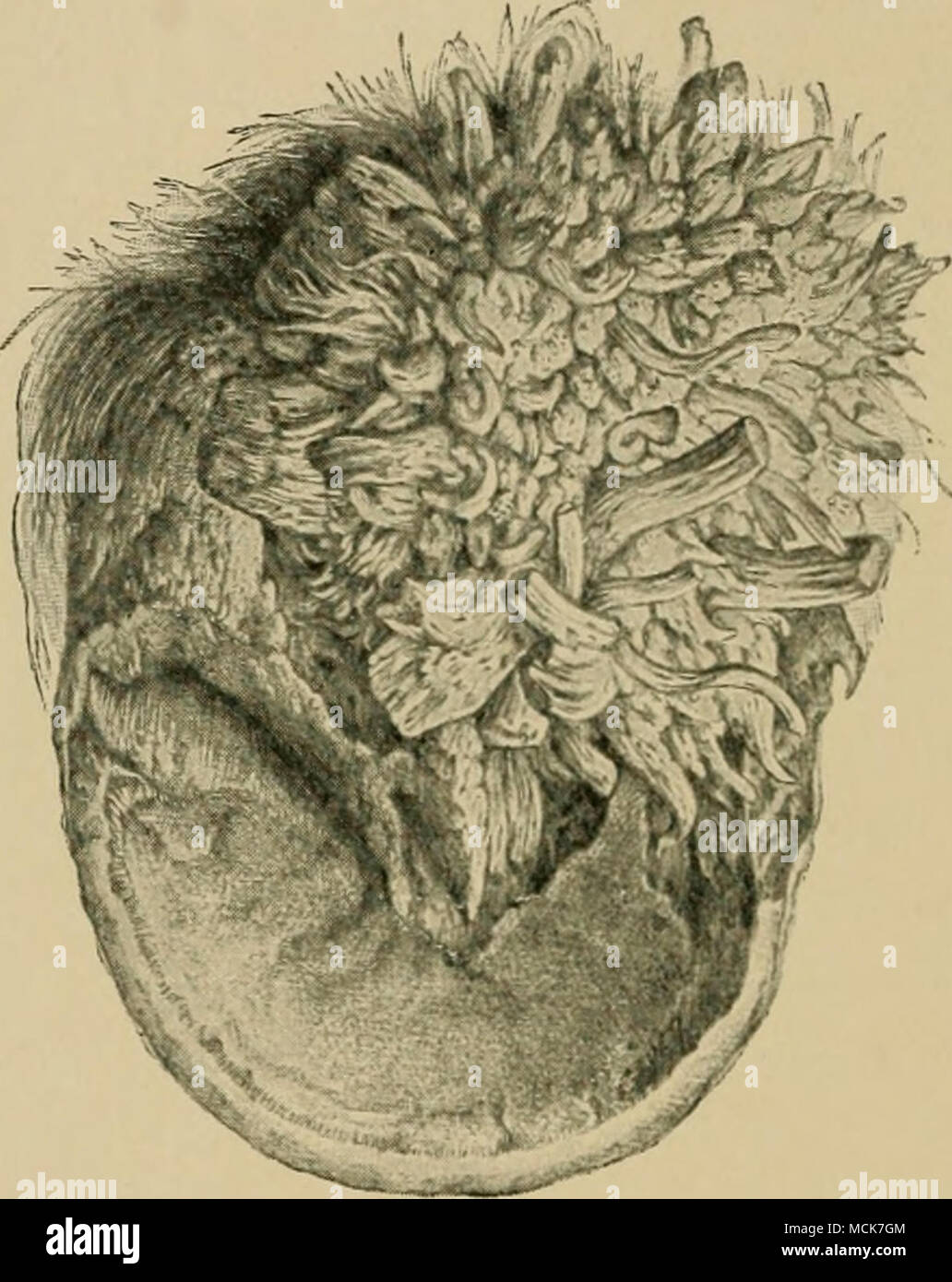 . Fig. 134.-A pied, l'objet de chancre, montrant la destruction de la ...