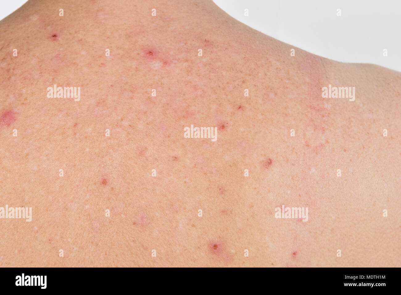 Dermatite atopique sur le dos d'une femme Photo Stock - Alamy