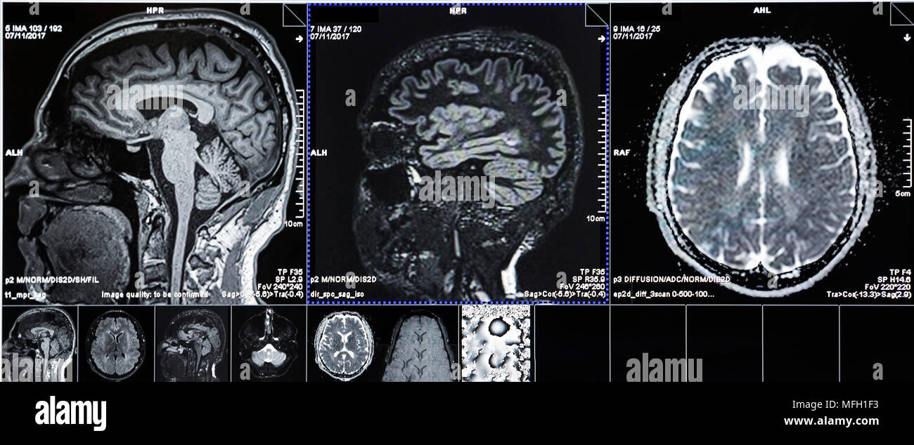 L'imagerie par résonance magnétique (IRM) - CT scan de la tête sur un ...
