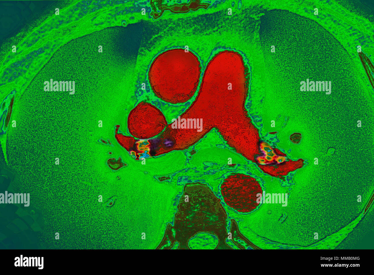 Embolie Pulmonaire Banque d'image et photos - Alamy