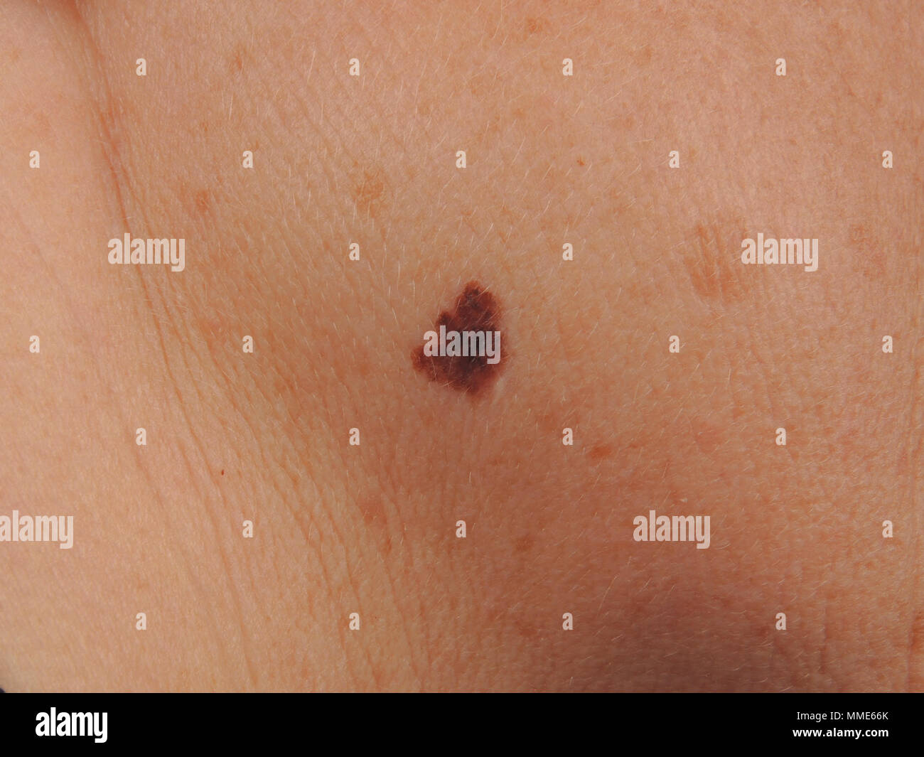 Mélanome cancer de la peau Banque de photographies et d’images à haute résolution - Page 4 - Alamy