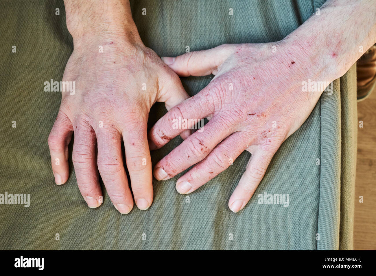 Eczéma dyshidrotique Banque de photographies et d’images à haute ...