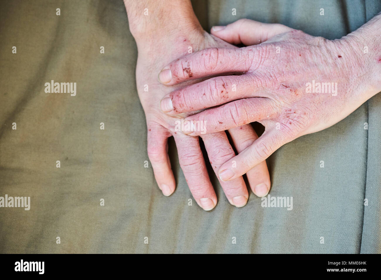 Eczéma dyshidrotique Banque de photographies et d’images à haute ...