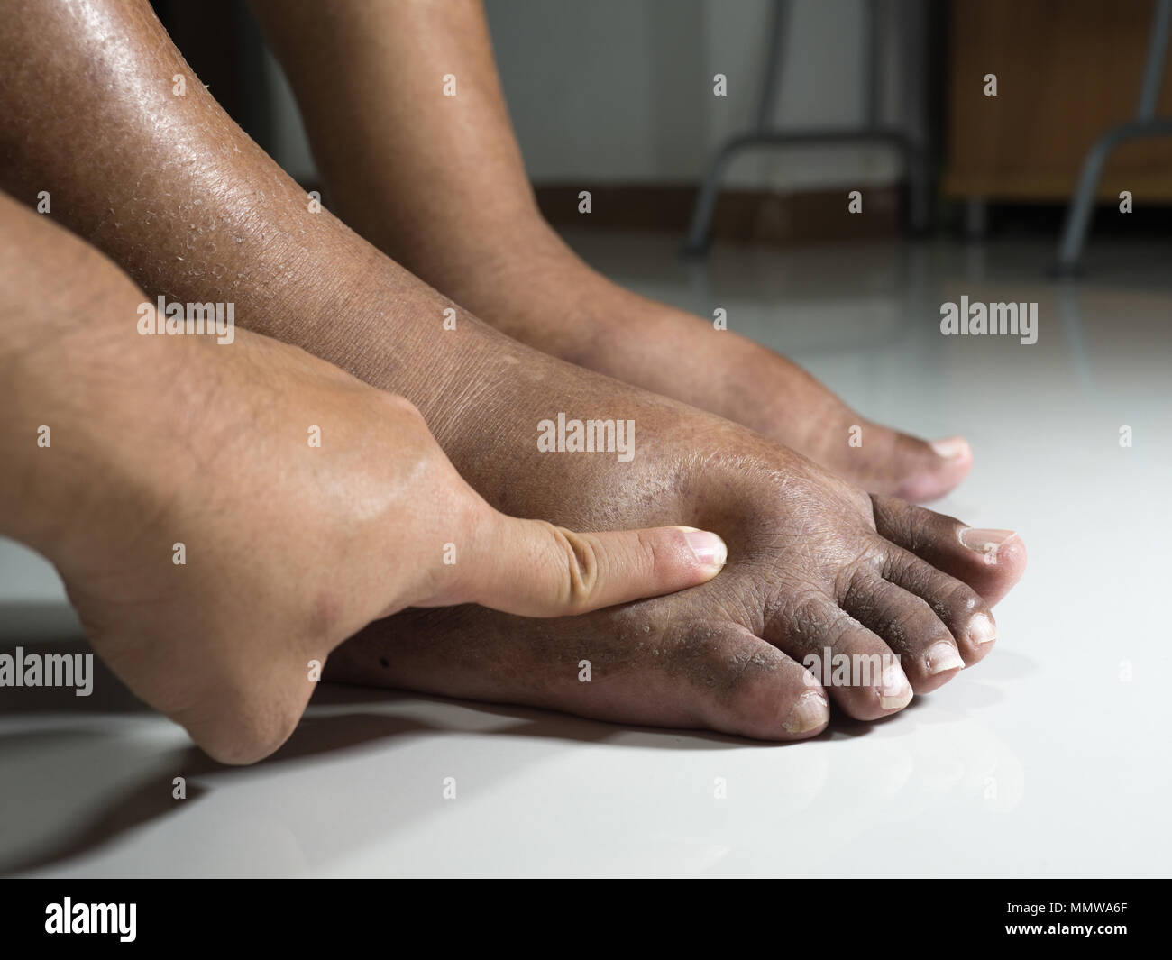 Pied diabétique Banque de photographies et d’images à haute résolution ...