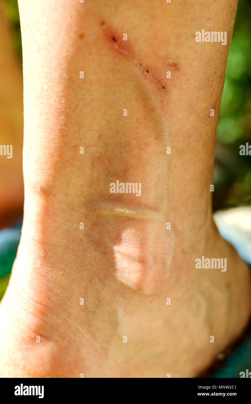 Maladie de peau sur les jambes Banque de photographies et d’images à ...