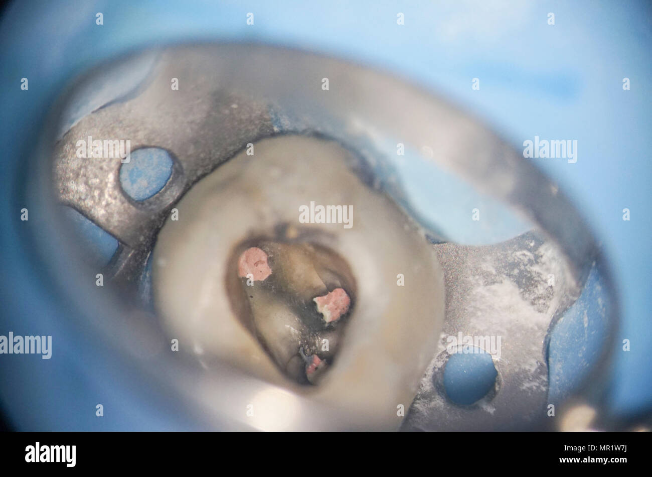 Dental canals Banque de photographies et d’images à haute résolution ...