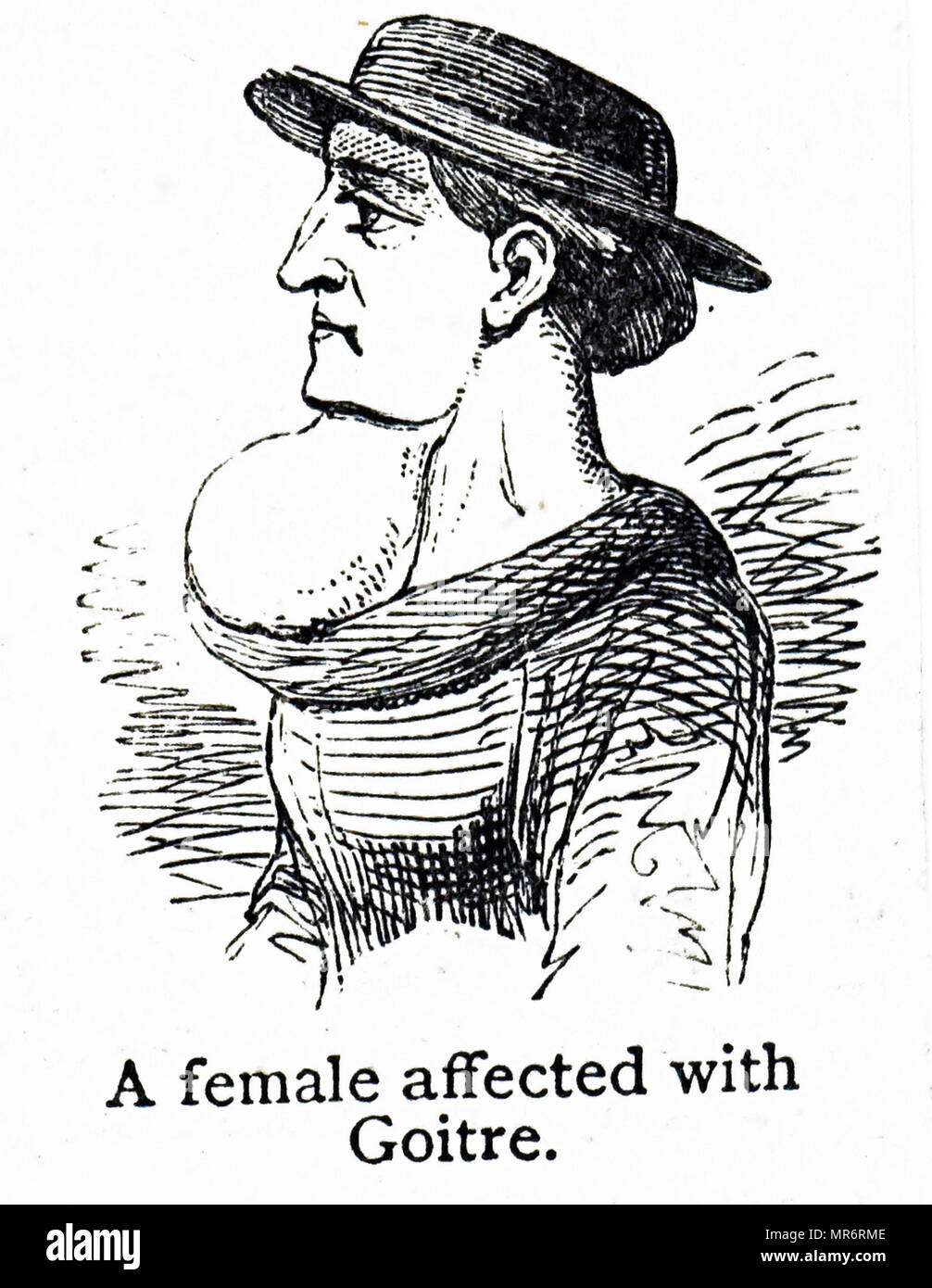 Gravure représentant une femme souffrant d'un goitre. Le goitre est le ...