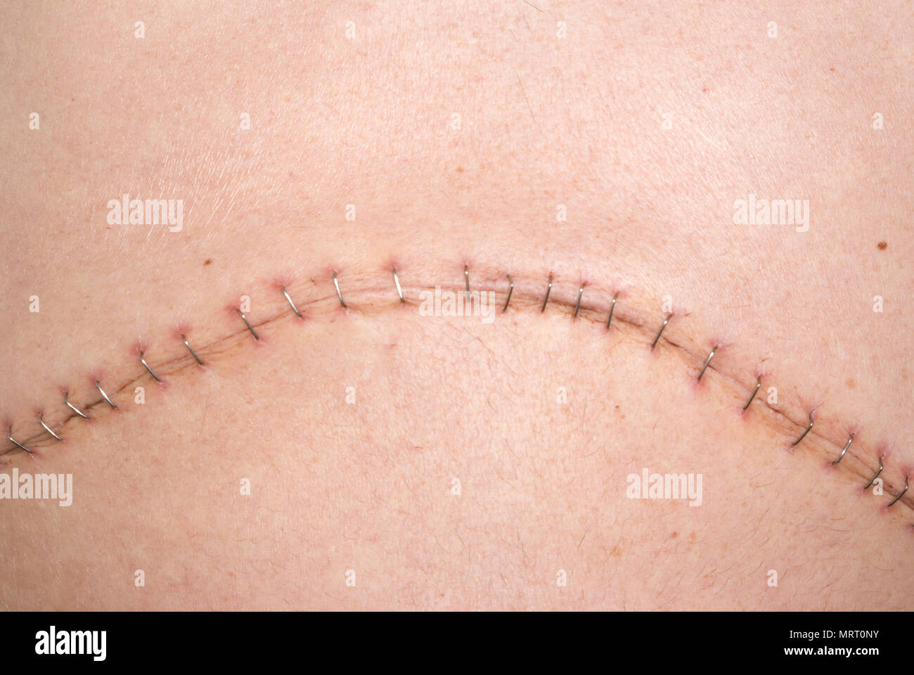 Incision abdominale Banque de photographies et d’images à haute ...