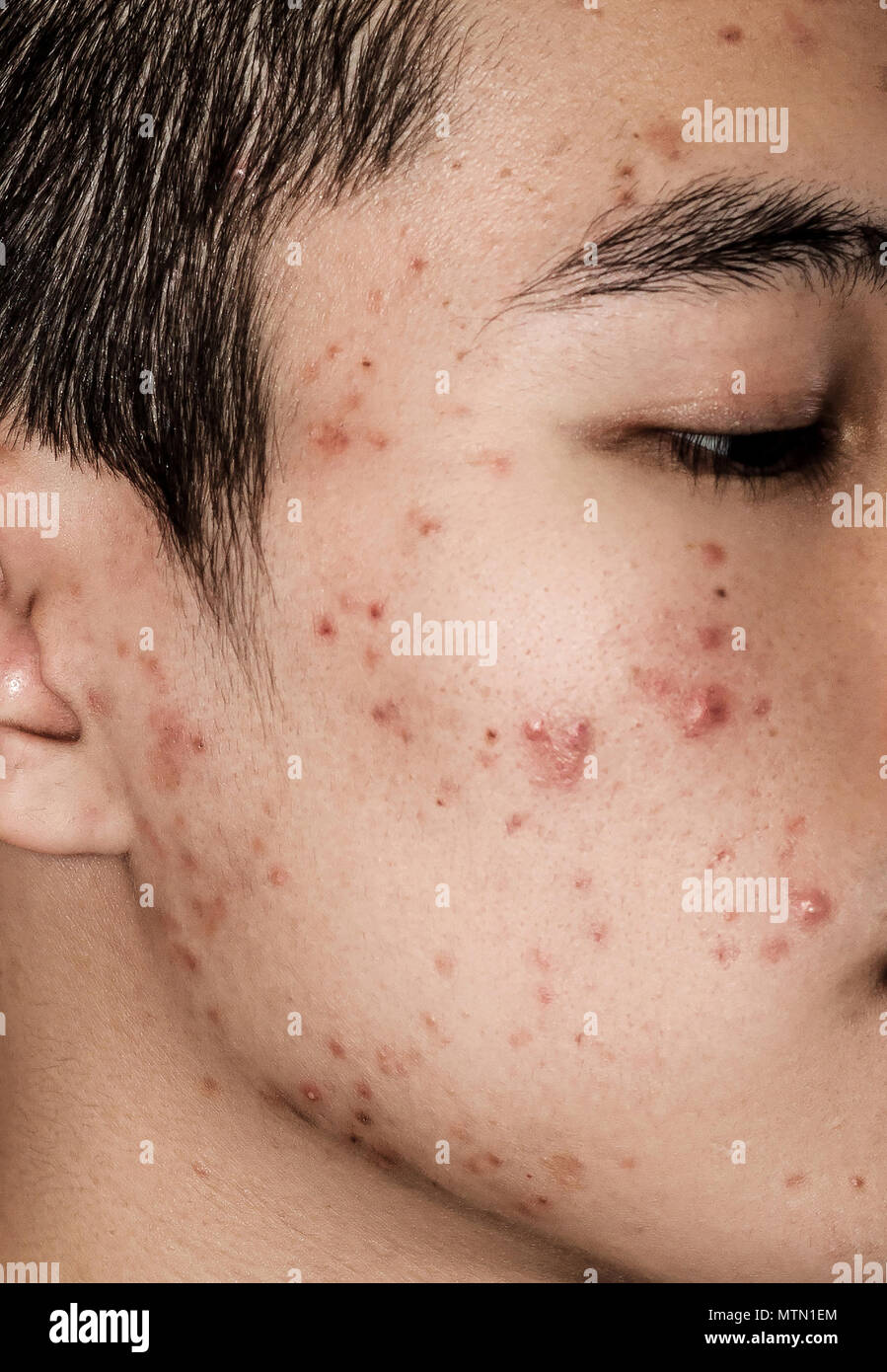 Maladie de peau visage Banque de photographies et d’images à haute ...
