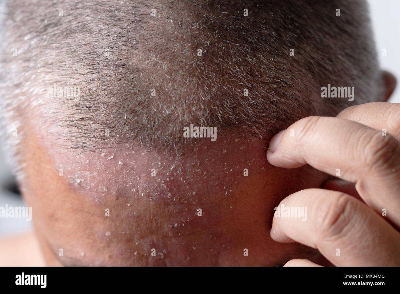 Maladie de peau cloque pustule Banque de photographies et d’images à ...