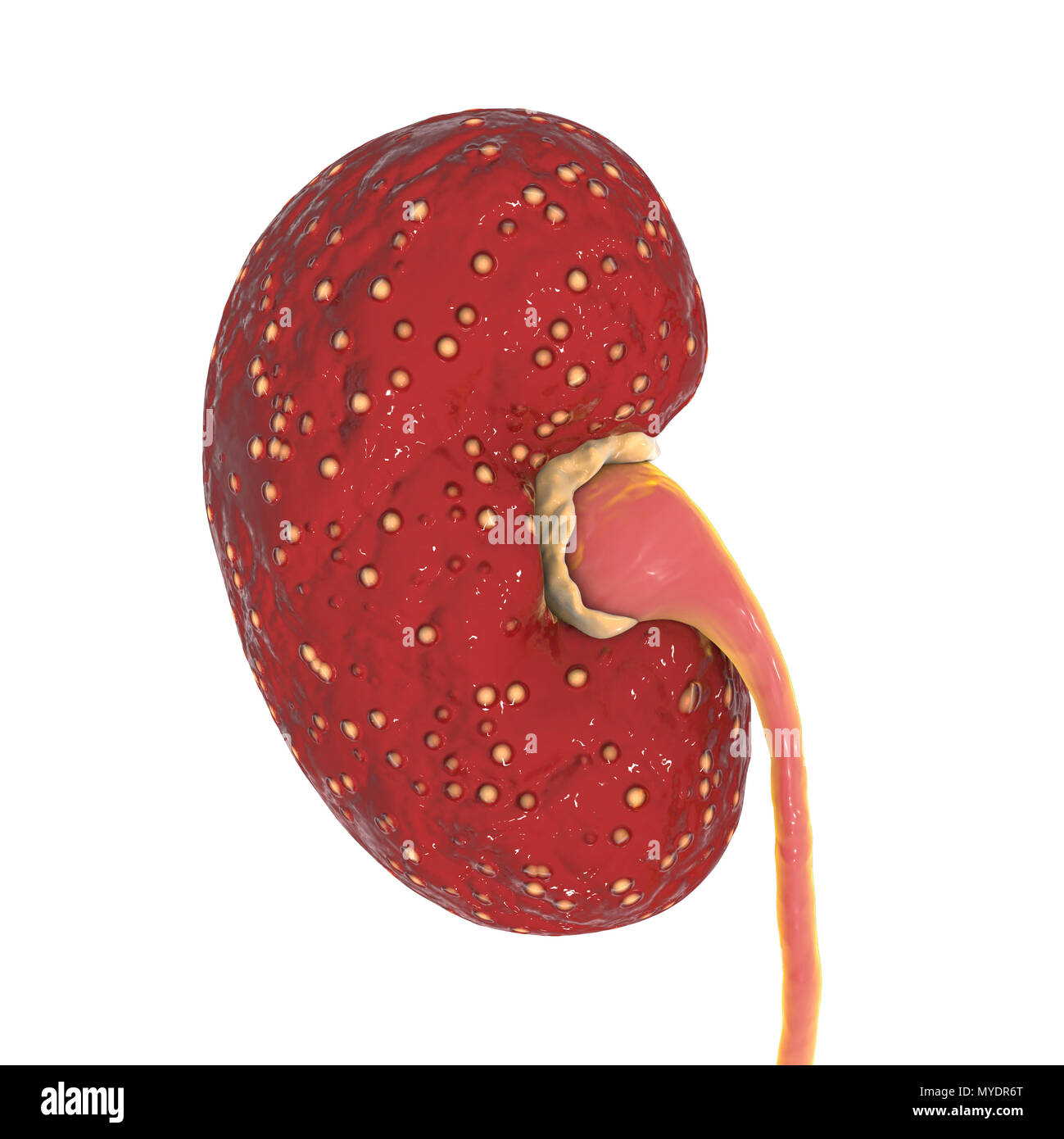 La pyélonéphrite aiguë. Illustration de petits abcès (jaune) sur la ...