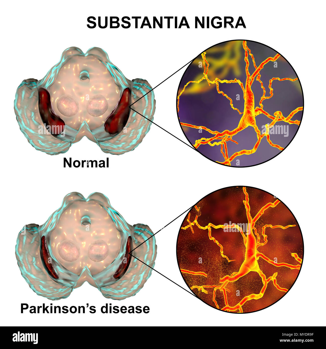 La substantia nigra. Illustration de l'ordinateur une substance noire ...