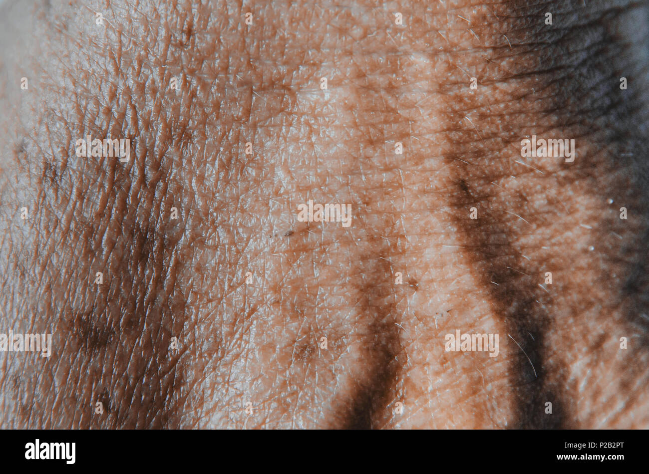 Cancer de la peau causé par le soleil Banque de photographies et d ...