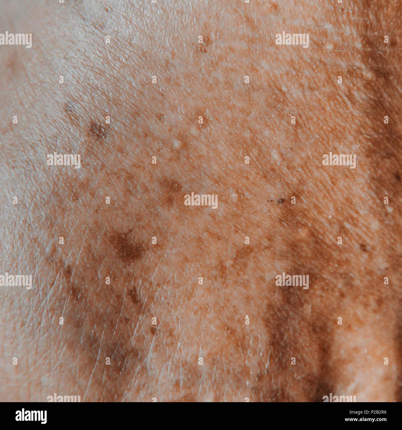 Cancer de la peau causé par le soleil Banque de photographies et d ...