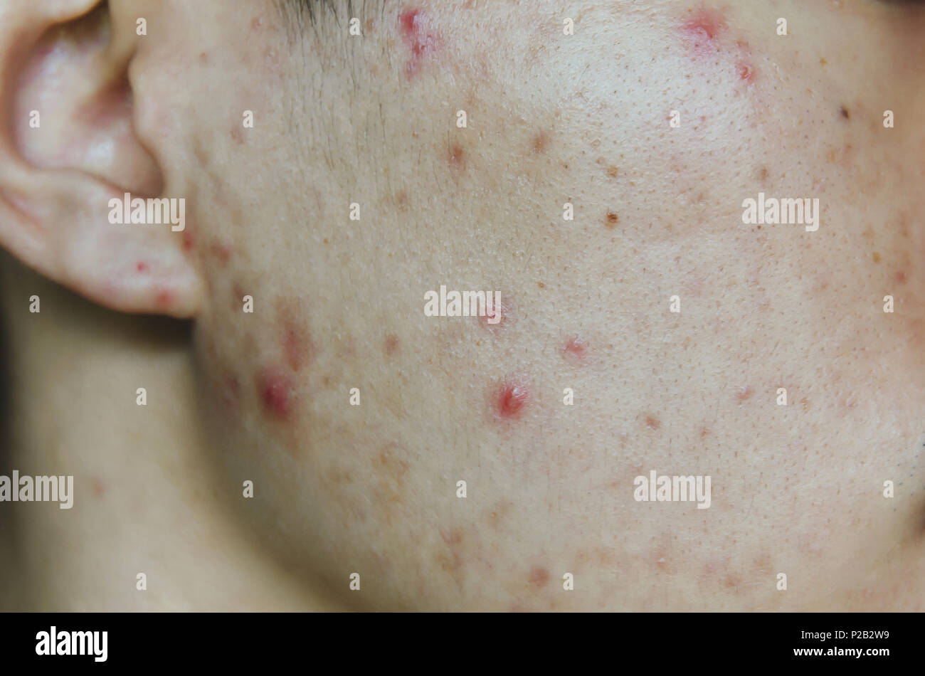 Maladie de peau bouton Banque de photographies et d’images à haute ...