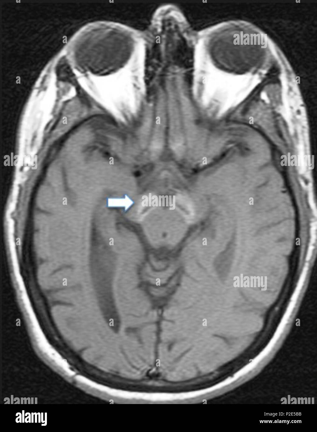 Substantia nigra Banque de photographies et d’images à haute résolution ...