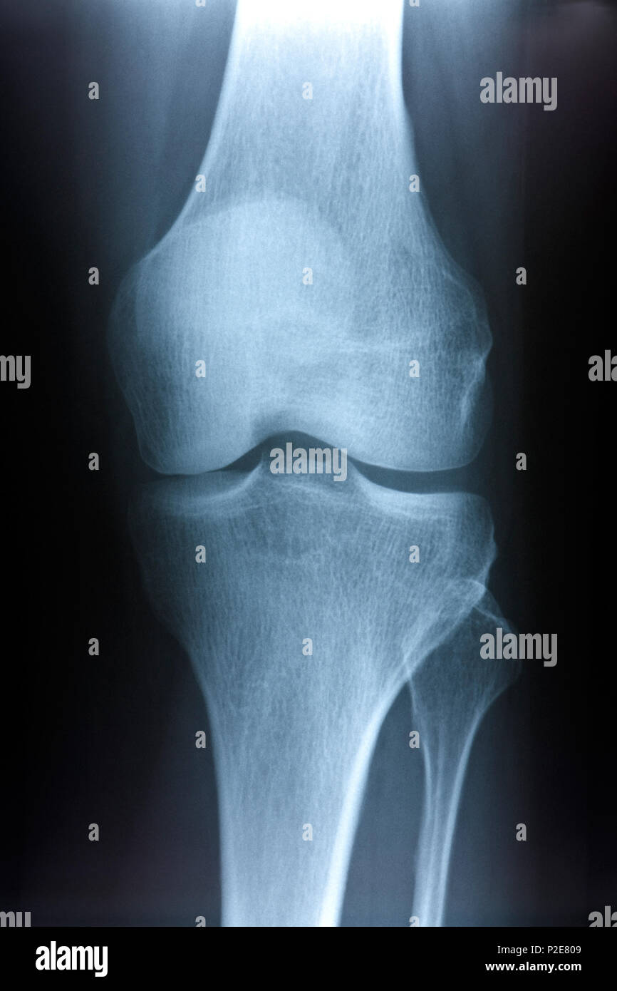 Radiographie d'une arthroplastie totale du genou Banque de ...