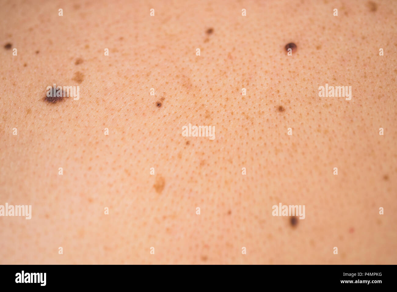 Benign Mole Photos & Benign Mole Images - Alamy