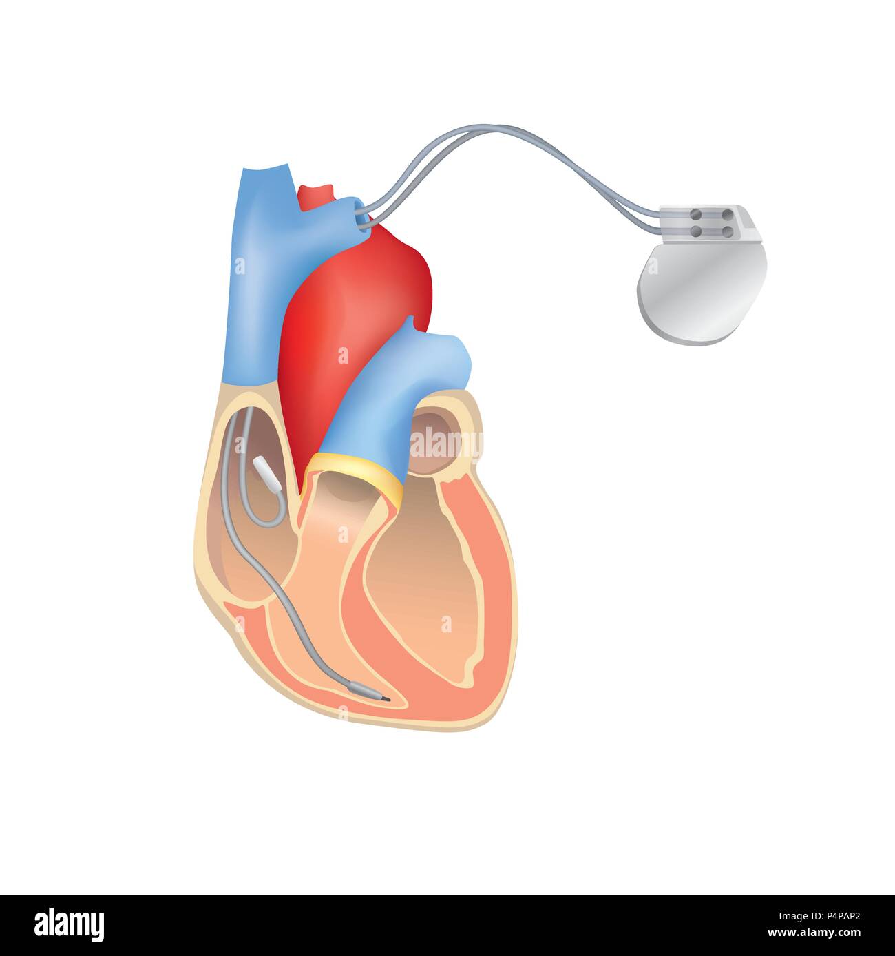 Stimulateur Cardiaque Artificiel Banque d'image et photos - Alamy