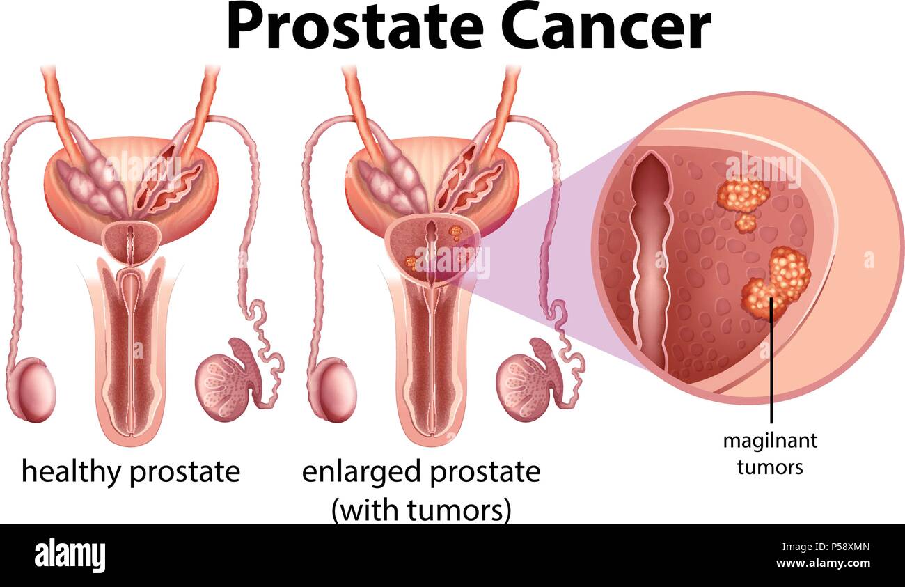 Cancer de la prostate Banque de photographies et d’images à haute résolution - Alamy