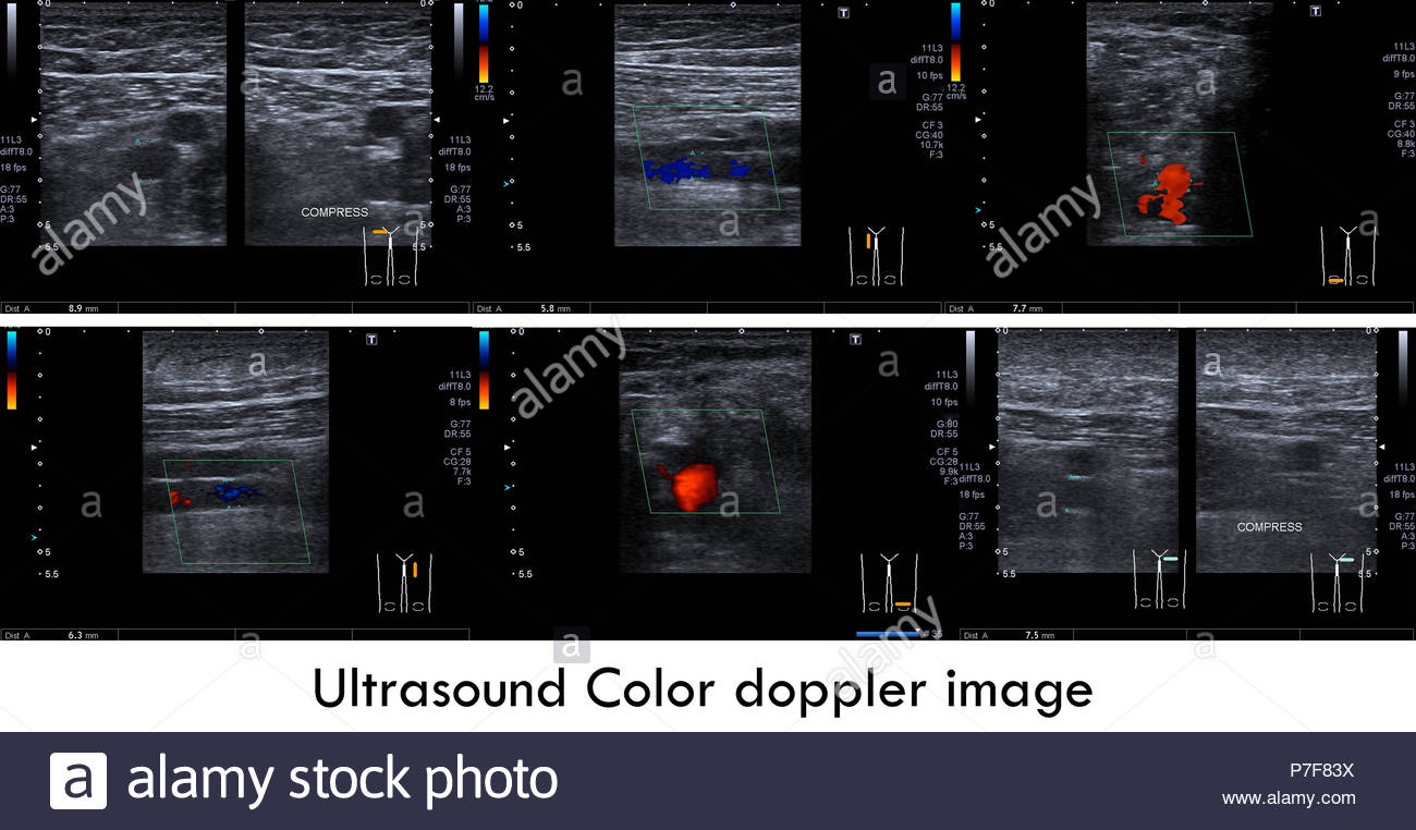 Aortic Valve Photos & Aortic Valve Images - Alamy