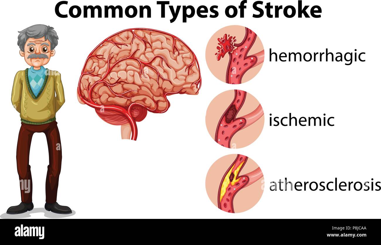 Types d'avc Banque de photographies et d’images à haute résolution - Alamy