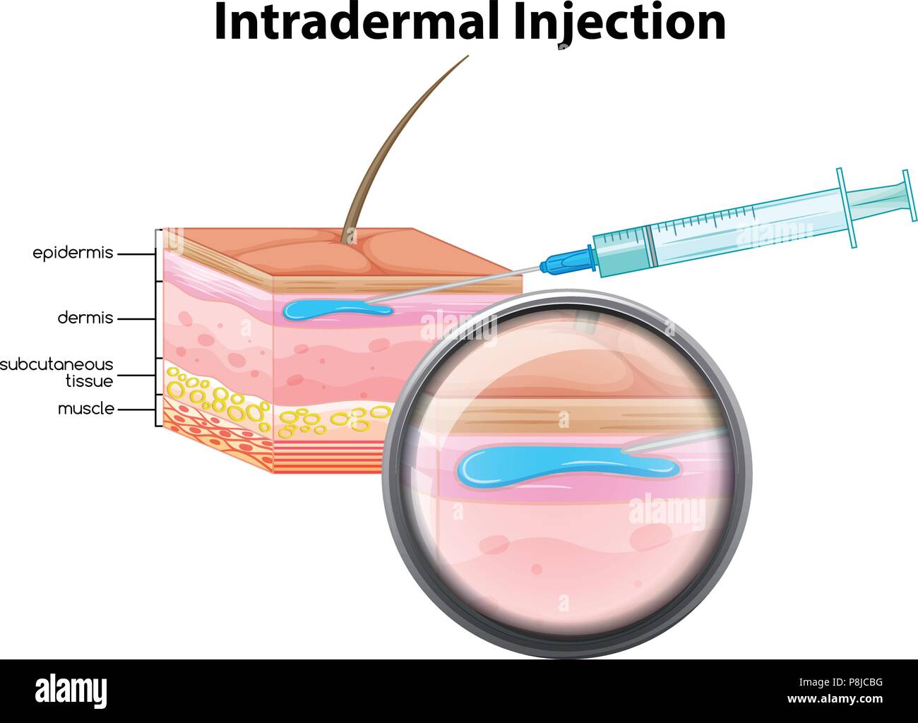 L'injection intradermique sur fond blanc illustration Image Vectorielle ...